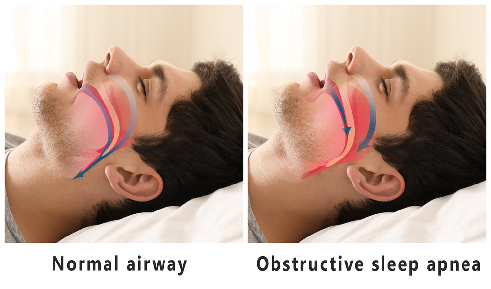 How Snoring Works | The Science Behind Nocturnal Noise – Snore Slayer